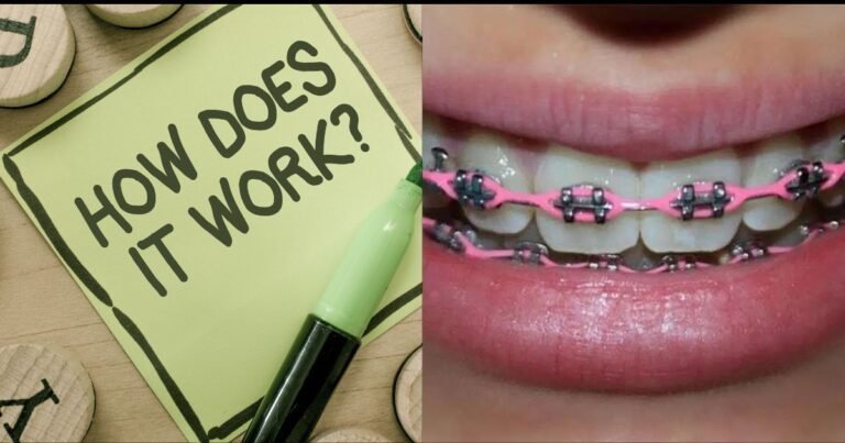 Power Chain Braces: uLTIMATE GUIDE 2025 - toothcareusa.com