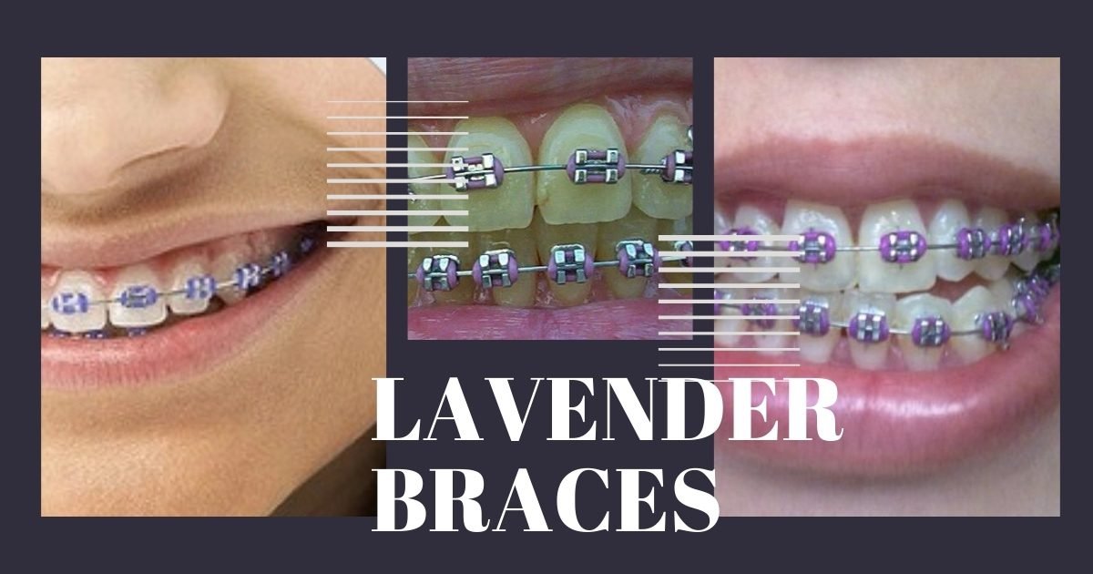 Lavender Braces: The Trendy Way to Add Style to Your Smile ...