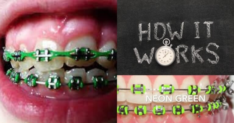 Green Braces: Are They Right for You? Pros, Cons, and Most valuable ...