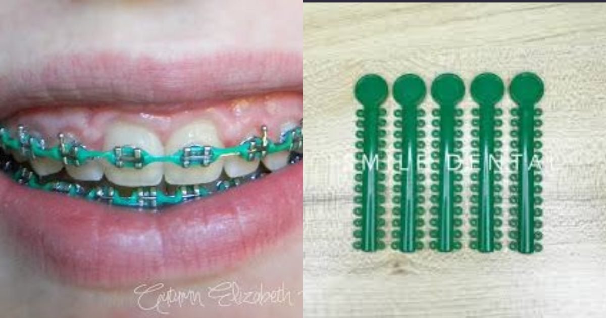 Green Braces: Are They Right for You? Pros, Cons, and Most valuable ...